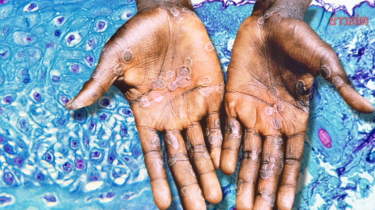 สวีเดน-อิตาลีผงะพบ “ป่วยฝีดาษลิง” รายแรก-ฝรั่งเศสเจอต้องสงสัยติดเชื้อ