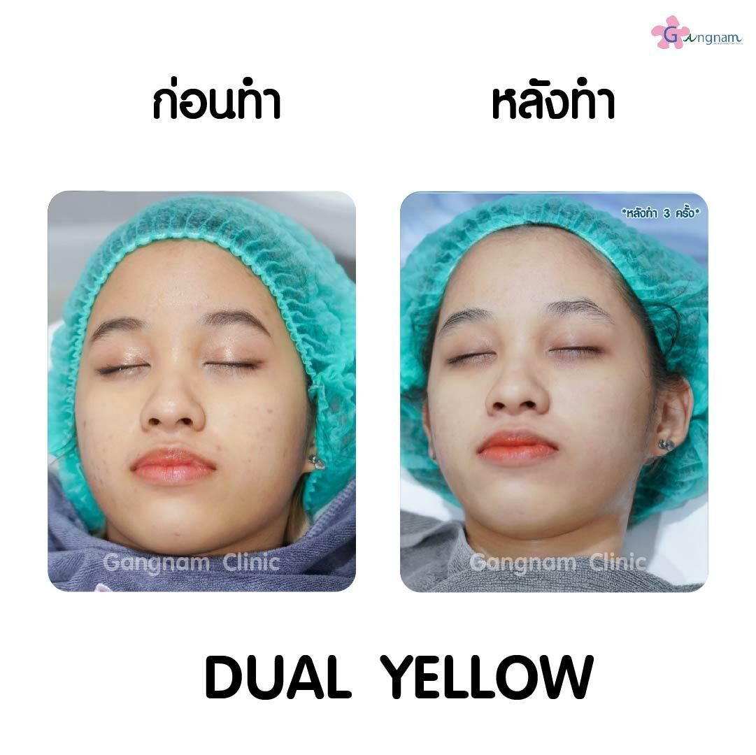 เลเซอร์หน้าใส Dual yellow ควรทำกี่ครั้ง อยากมีผิวหน้าสุขภาพดีต้องอ่าน ...