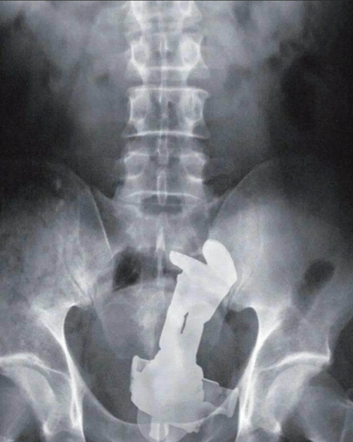 แพทย์งง! พบตุ๊กตา “บัซ ไลท์เยียร์ Toy Story” ติดอยู่ในทวารหนักของผู้ป่วย