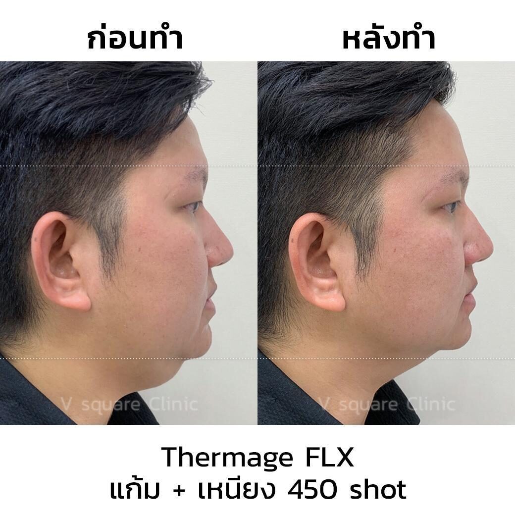 Thermage FLX คืออะไร ? ทำเทอร์มาจ FLX ดีไหม ? จุดเด่น ข้อดี-ข้อเสีย